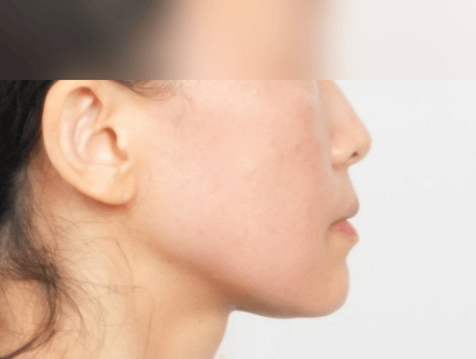 올타이트(ALLTITE) | DLTD 단독 신기술