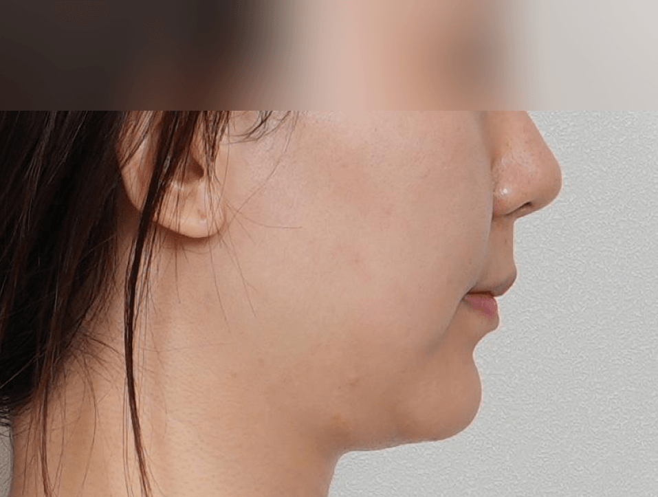 올타이트(ALLTITE) | DLTD 단독 신기술