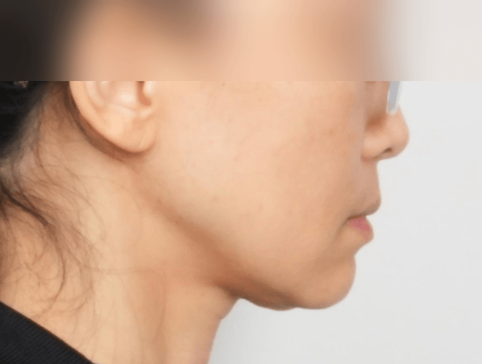 올타이트(ALLTITE) | DLTD 단독 신기술