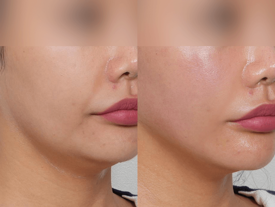 올타이트(ALLTITE) | DLTD 단독 신기술